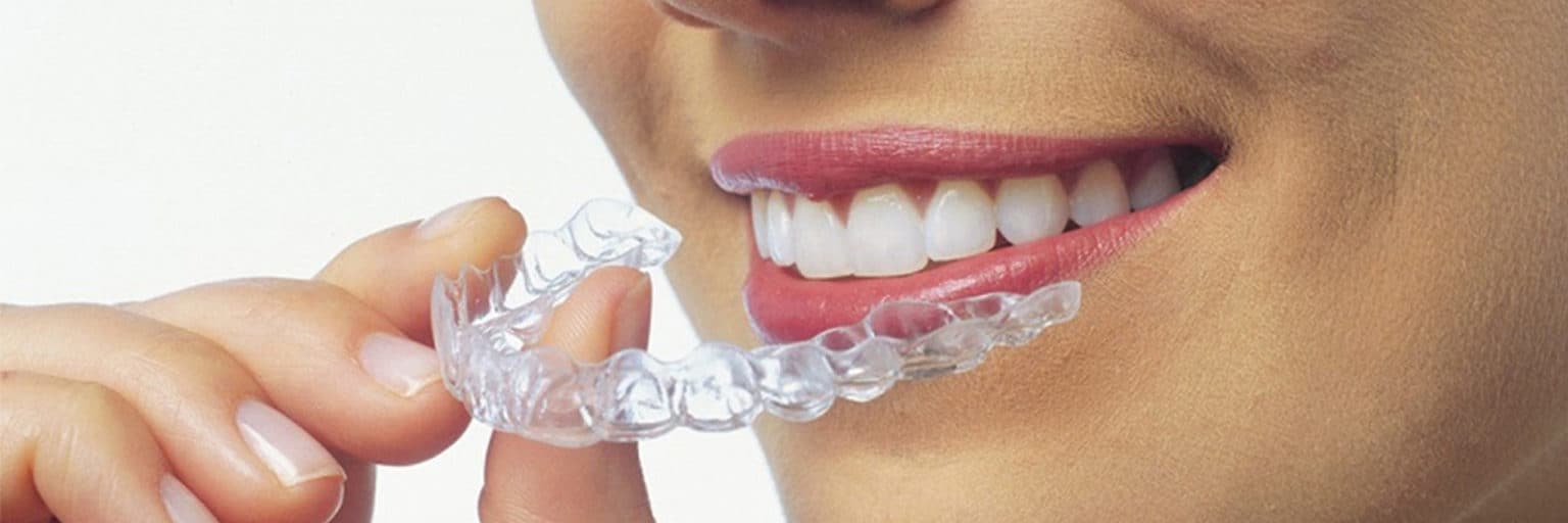 Invisible orthodontics - Smile Designers UK